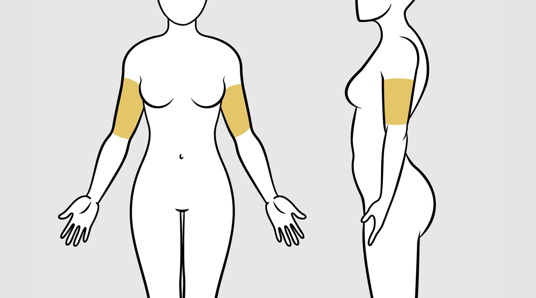 Arm Liposuction Phoenix Phoenix Liposuction