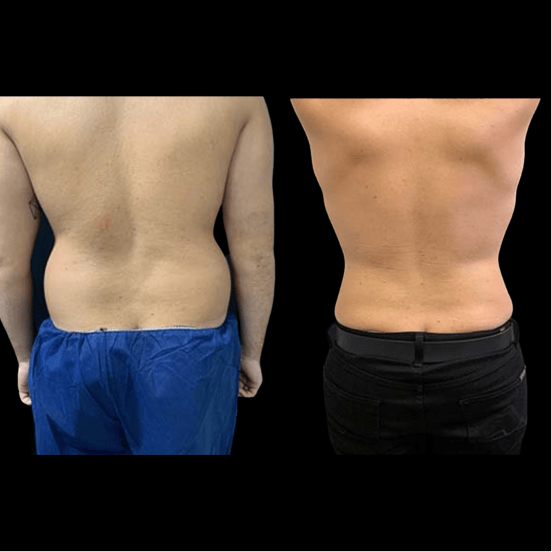 Male Liposuction Love Handles: Procedure & Quick Recovery