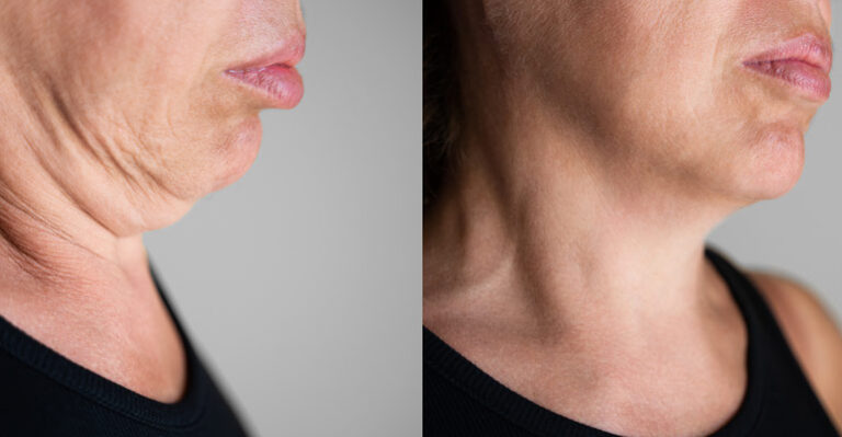 Neck Liposuction: Procedure and What to Expect in Recovery